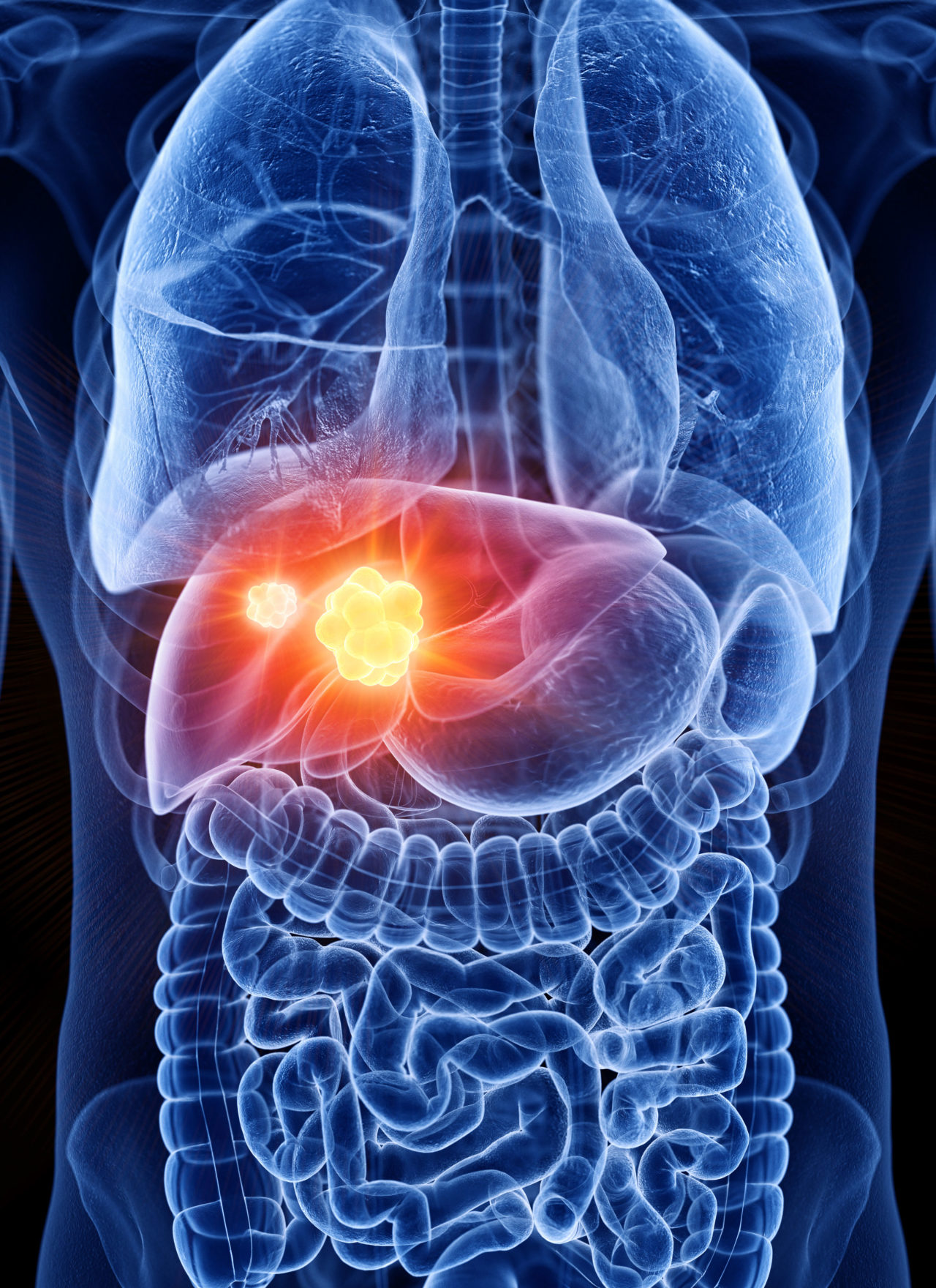 The Immunological and Metabolic Landscape in Primary and Metastatic ...